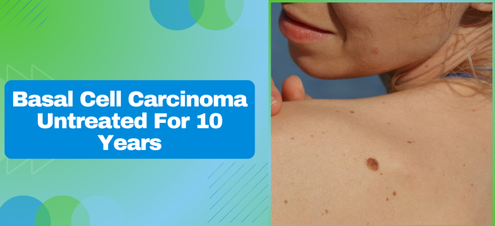Basal cell carcinoma untreated for 10 years | Dr Leena Jain