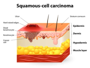 Squamous Cell Skin Cancer on Leg | Dr. Leena Jain